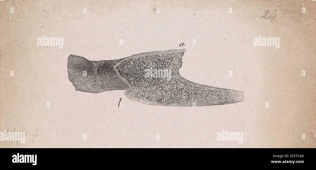 Human bone with a deviation Stock Photo - Alamy