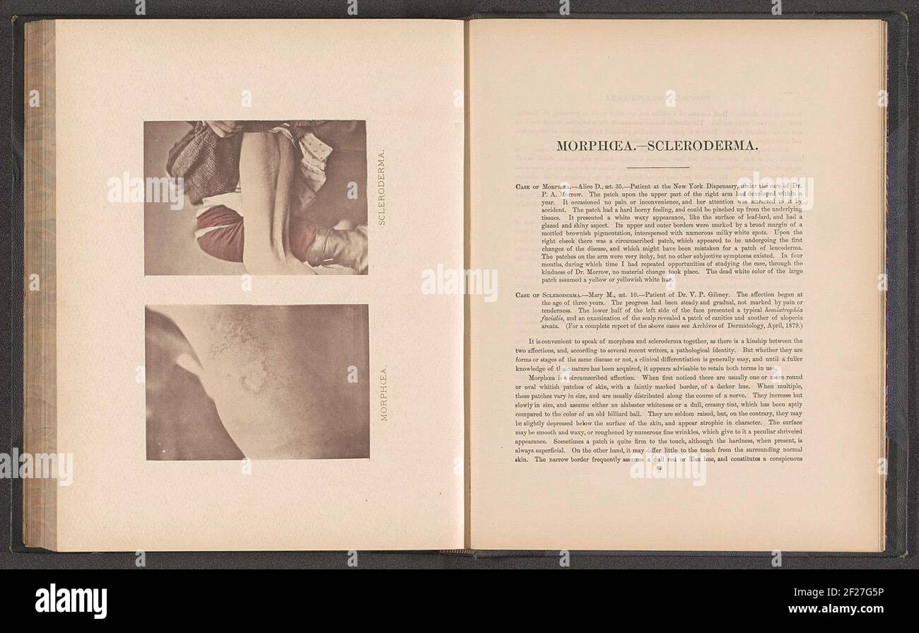 Patients suffering from the skin disease 'Morphœa' and 'scleroderma ...