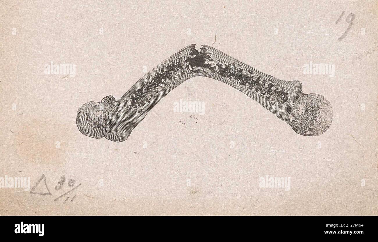 Human bone with a deviation Stock Photo - Alamy