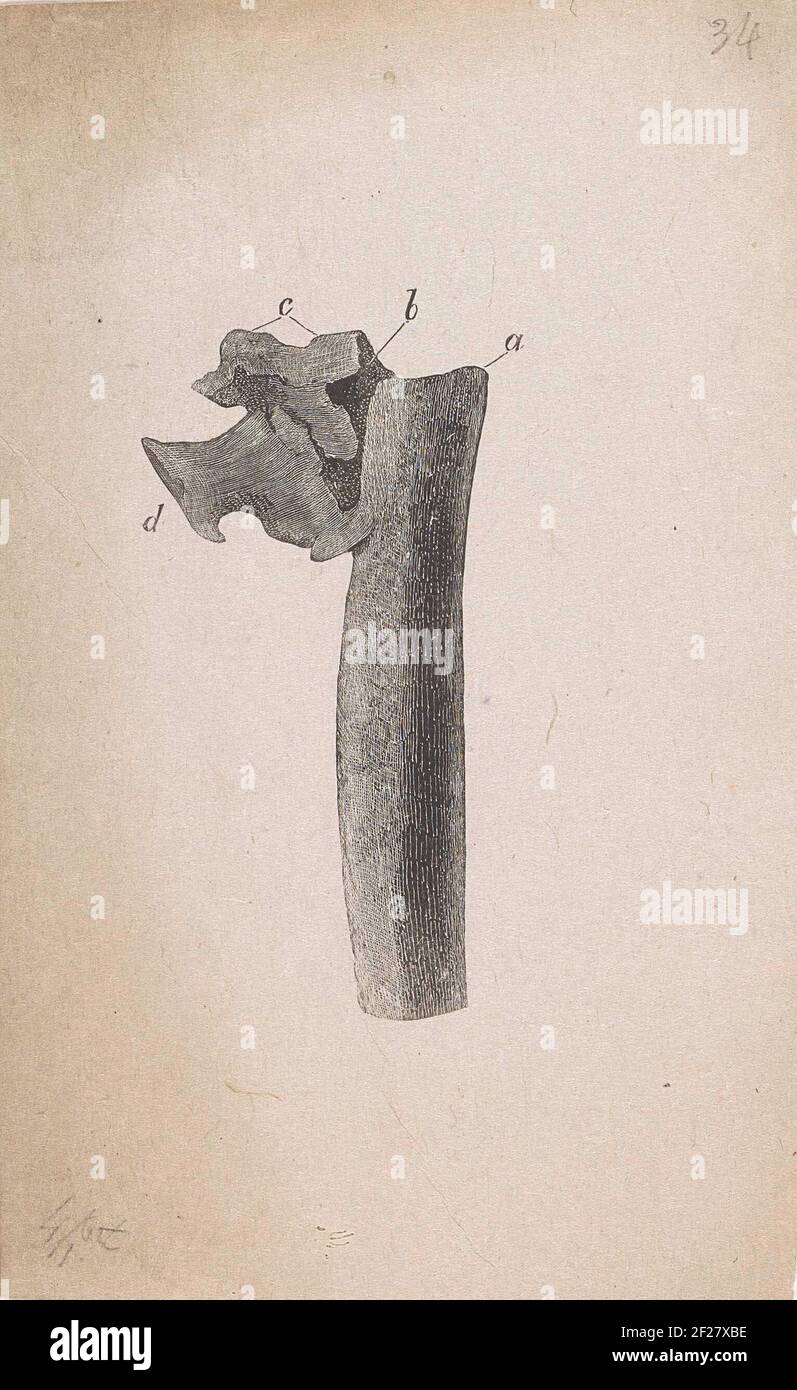Human bone with a deviation Stock Photo - Alamy