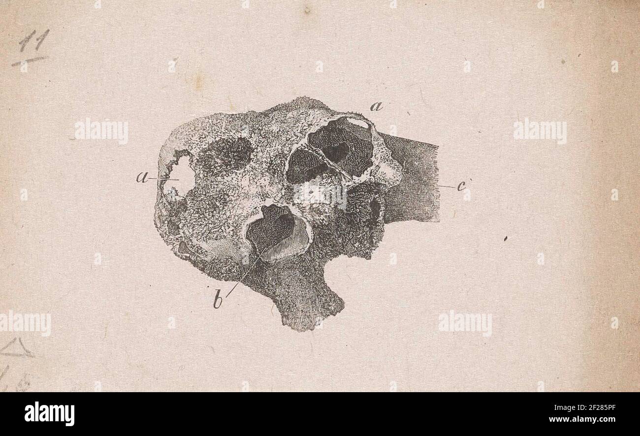 Human bone with a deviation Stock Photo - Alamy