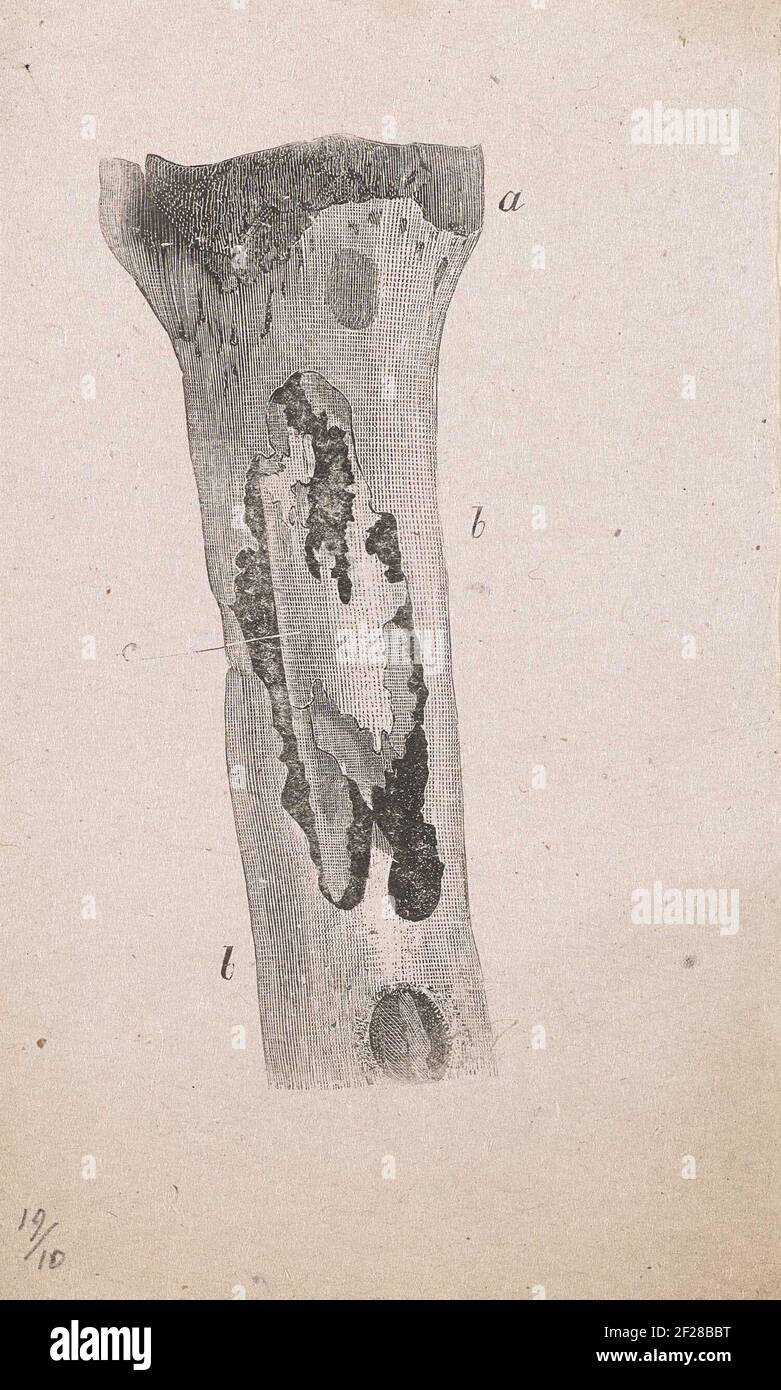 Human bone with a deviation Stock Photo - Alamy