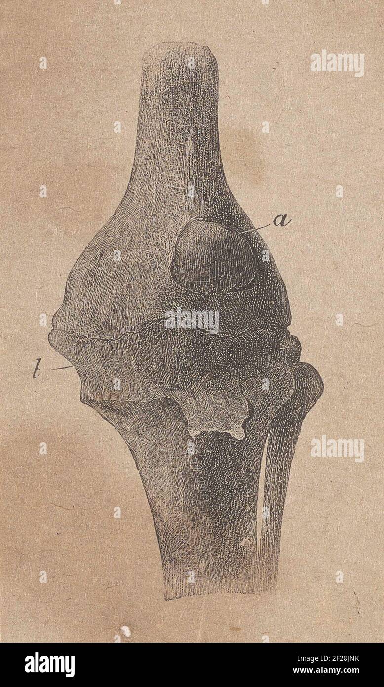 Human bone deviation hi-res stock photography and images - Alamy
