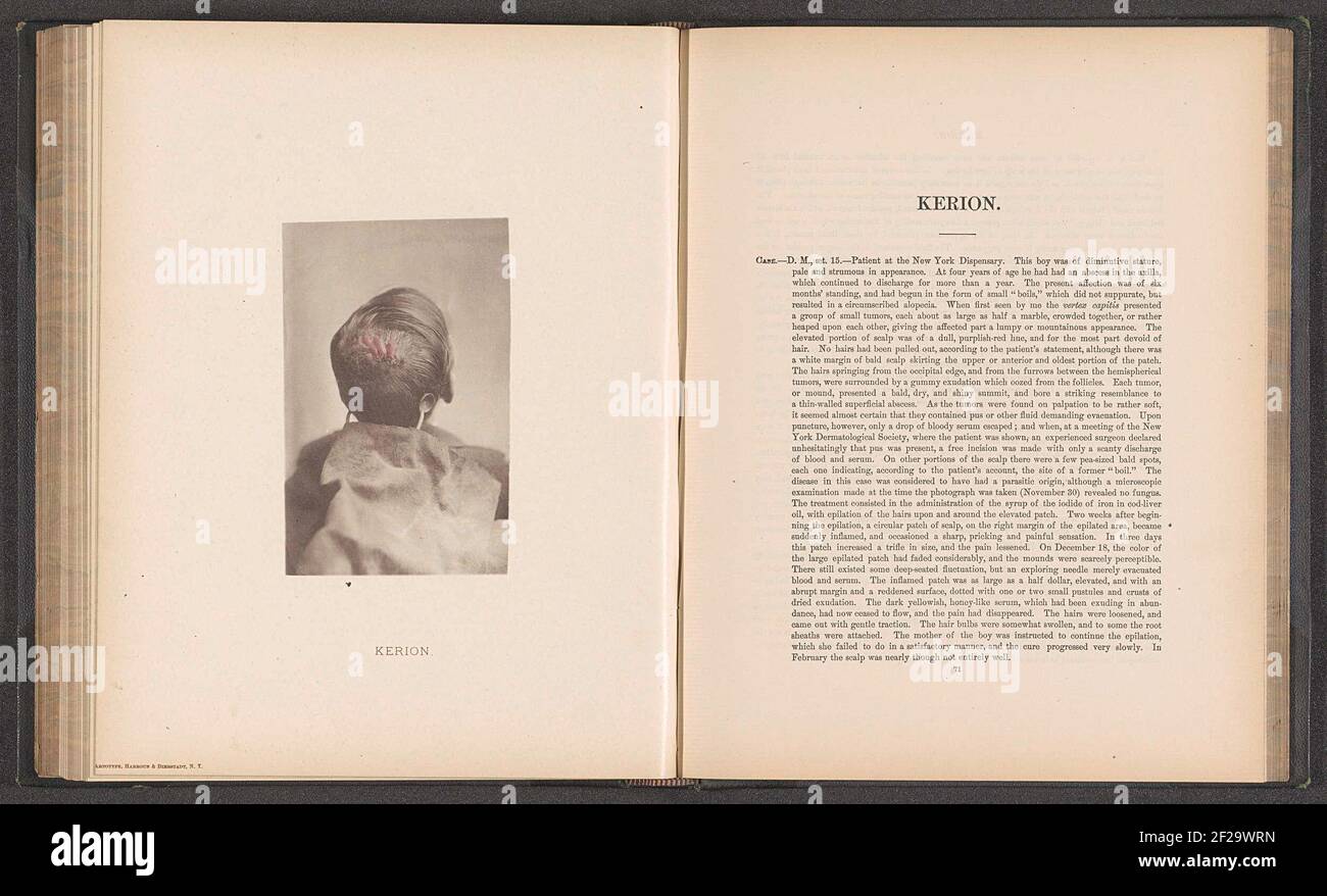 Kerion hi-res stock photography and images - Alamy