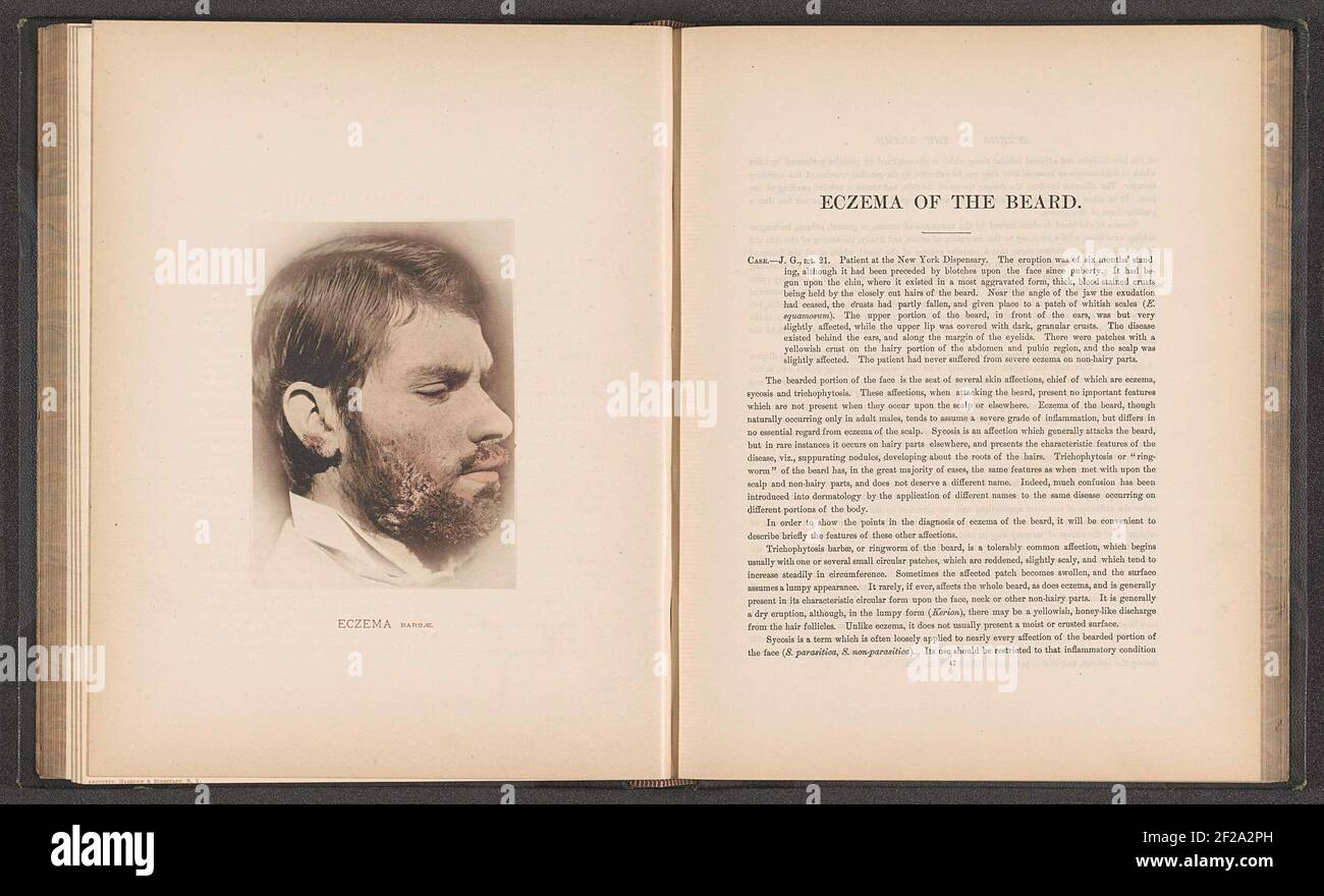 Patient suffering from the skin disease 'Eczema Barbae'; Eczema Barbae ...