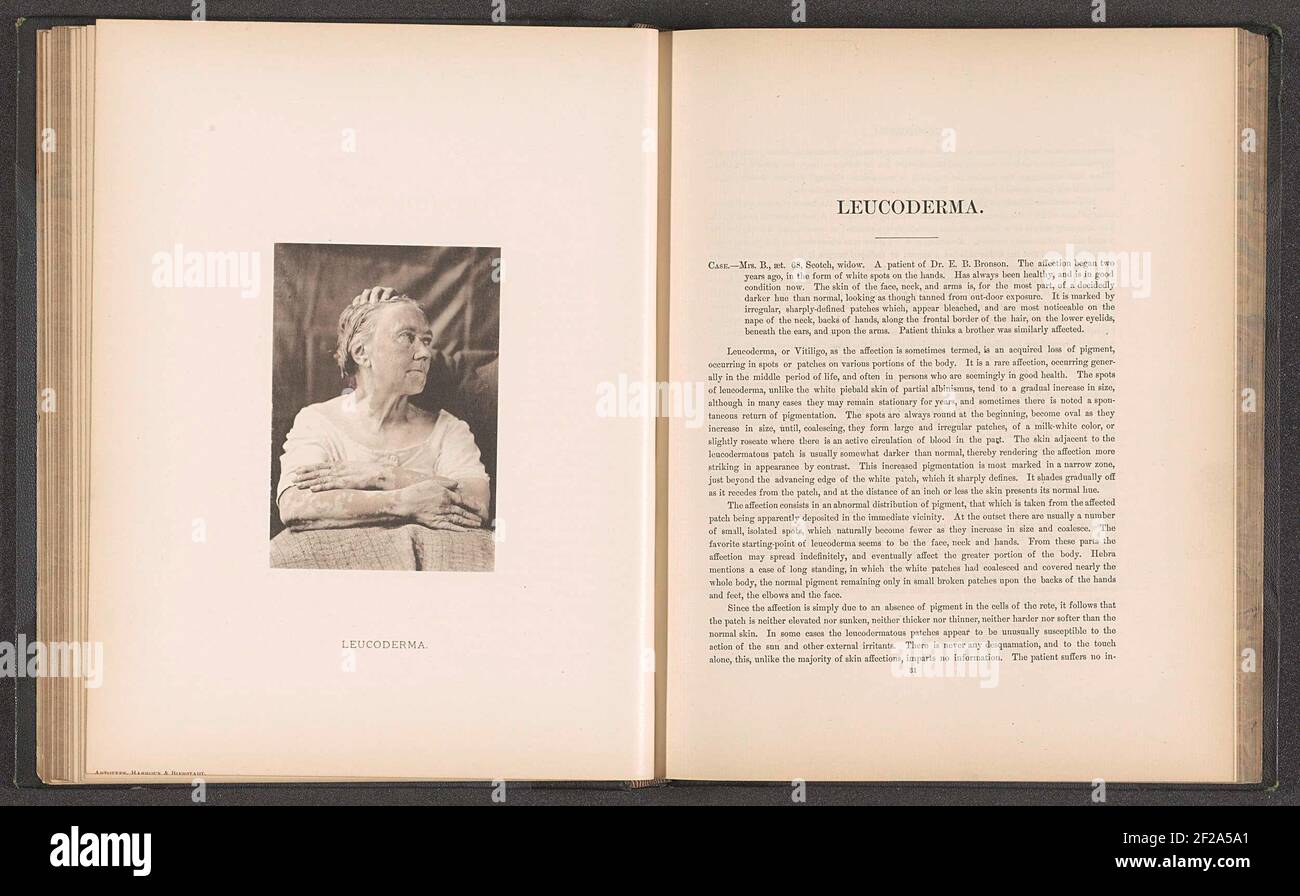 Patient suffering from the "Leucoderma" skin disease; Leucoderma Stock ...