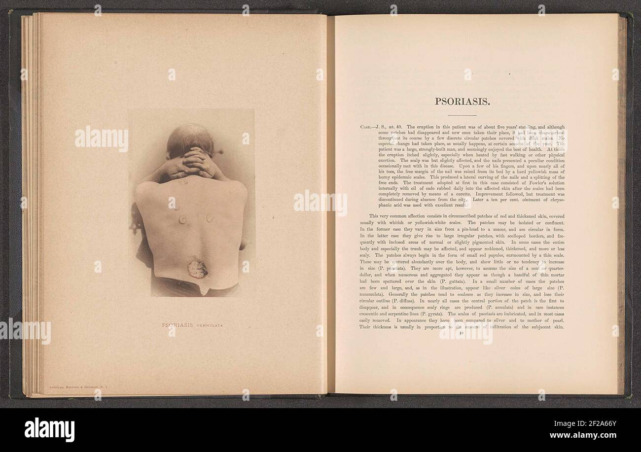 Patient suffering from the skin disease 'psoriasis nummulata ...