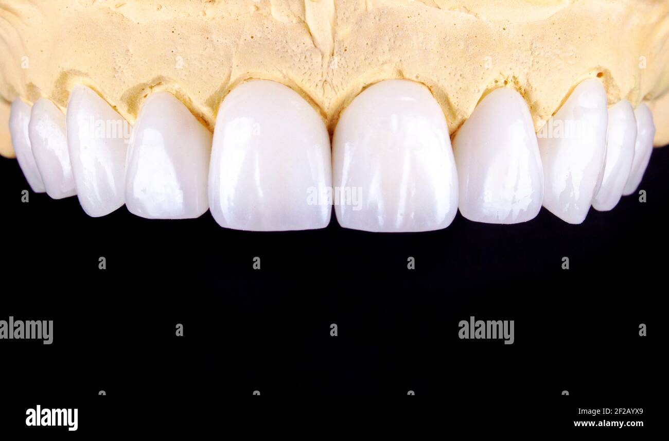 Perfect smile before and after veneers bleach of zircon arch ceramic ...