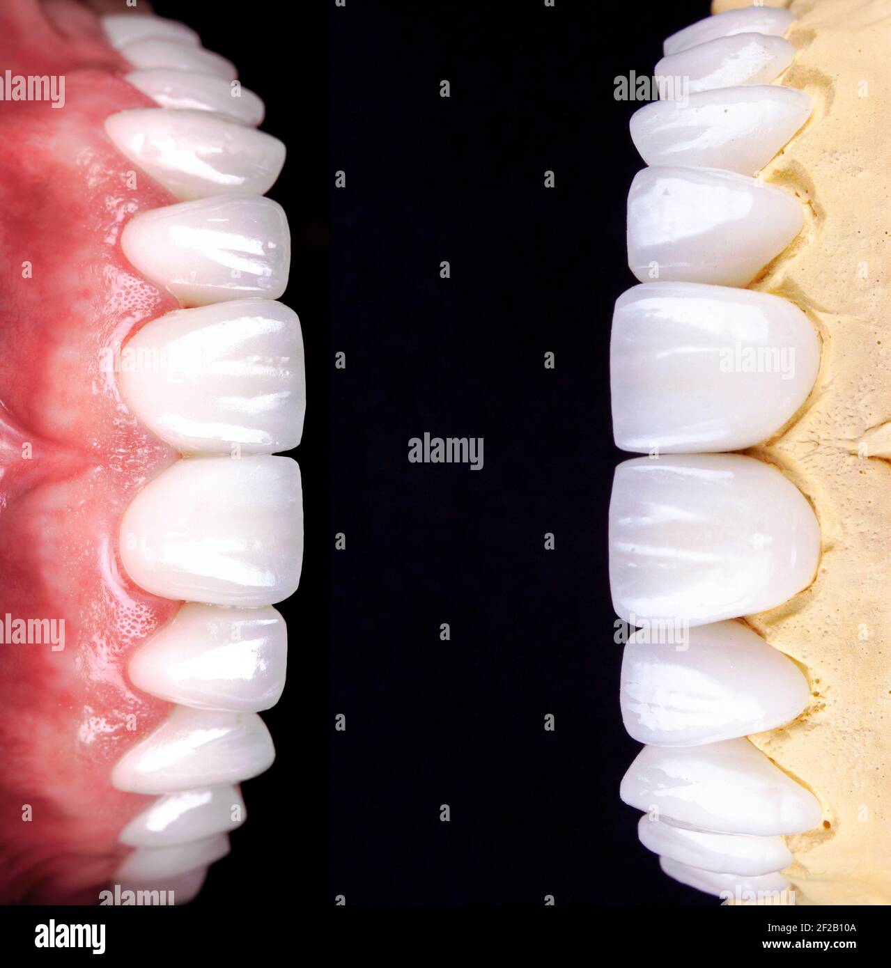 Perfect smile before and after veneers bleach of zircon arch ceramic ...