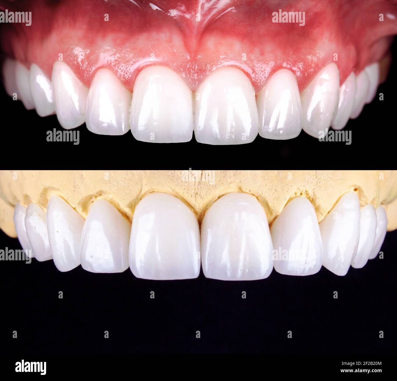Before after surgery implants hi-res stock photography and images - Alamy