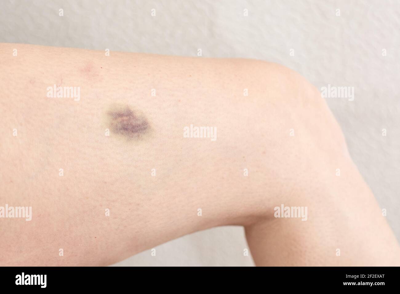 A bruised leg hi-res stock photography and images - Alamy