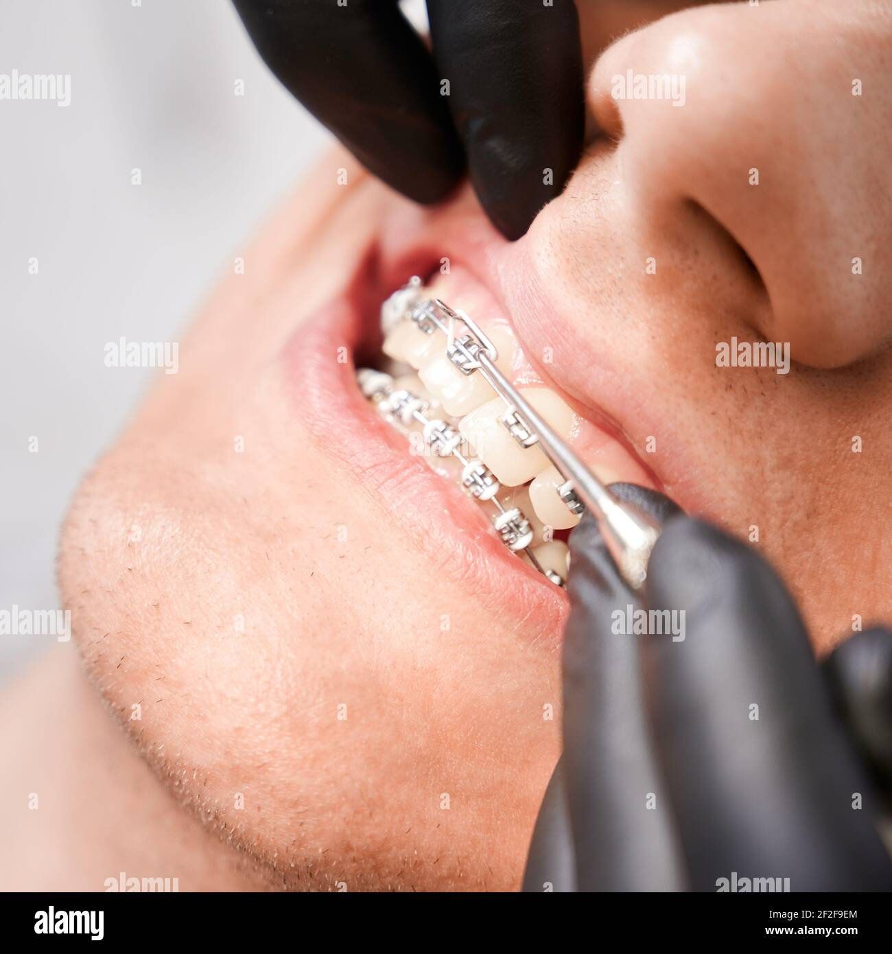 Male braces hi-res stock photography and images - Alamy