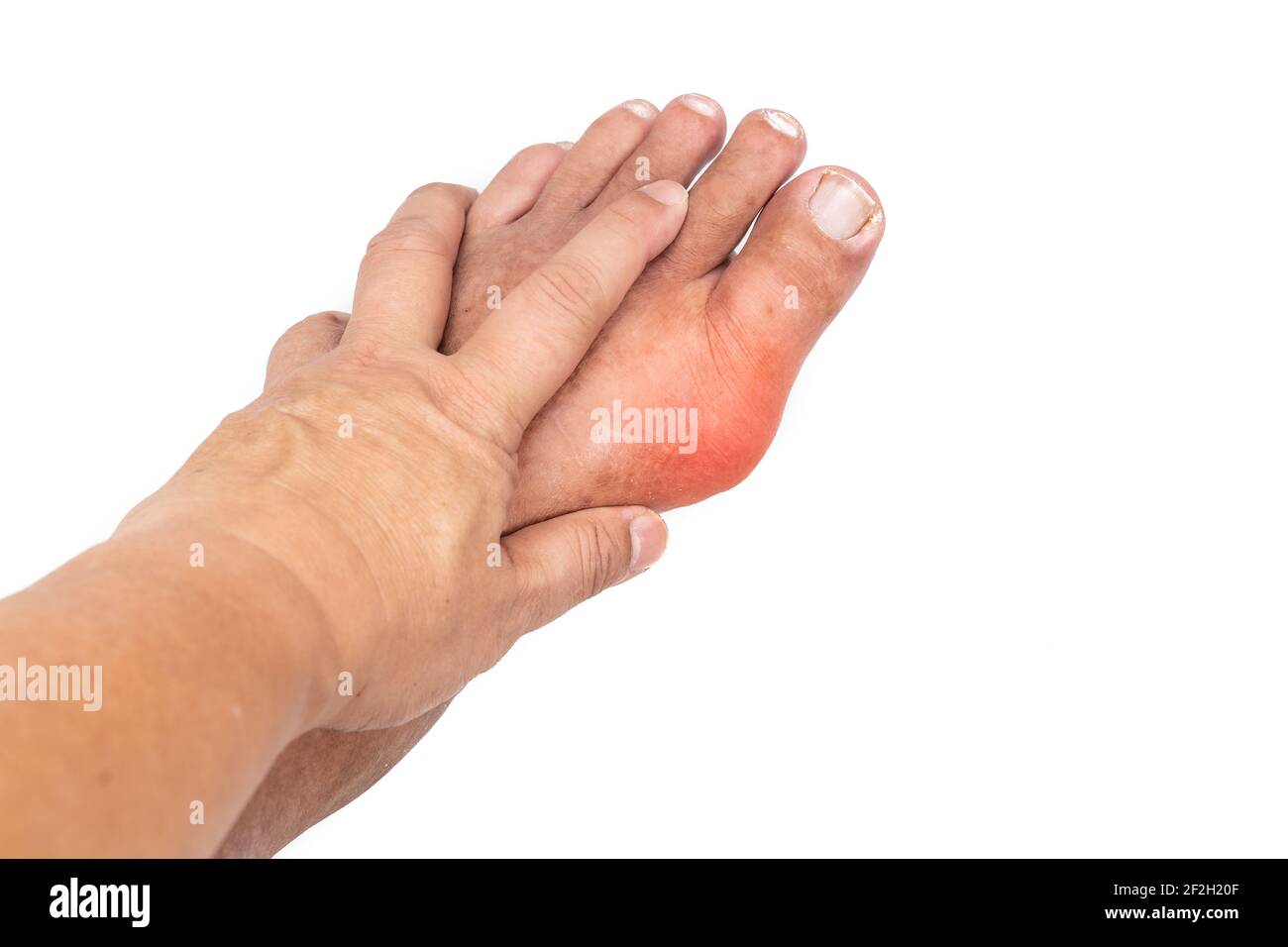 Gout foot hi-res stock photography and images - Alamy
