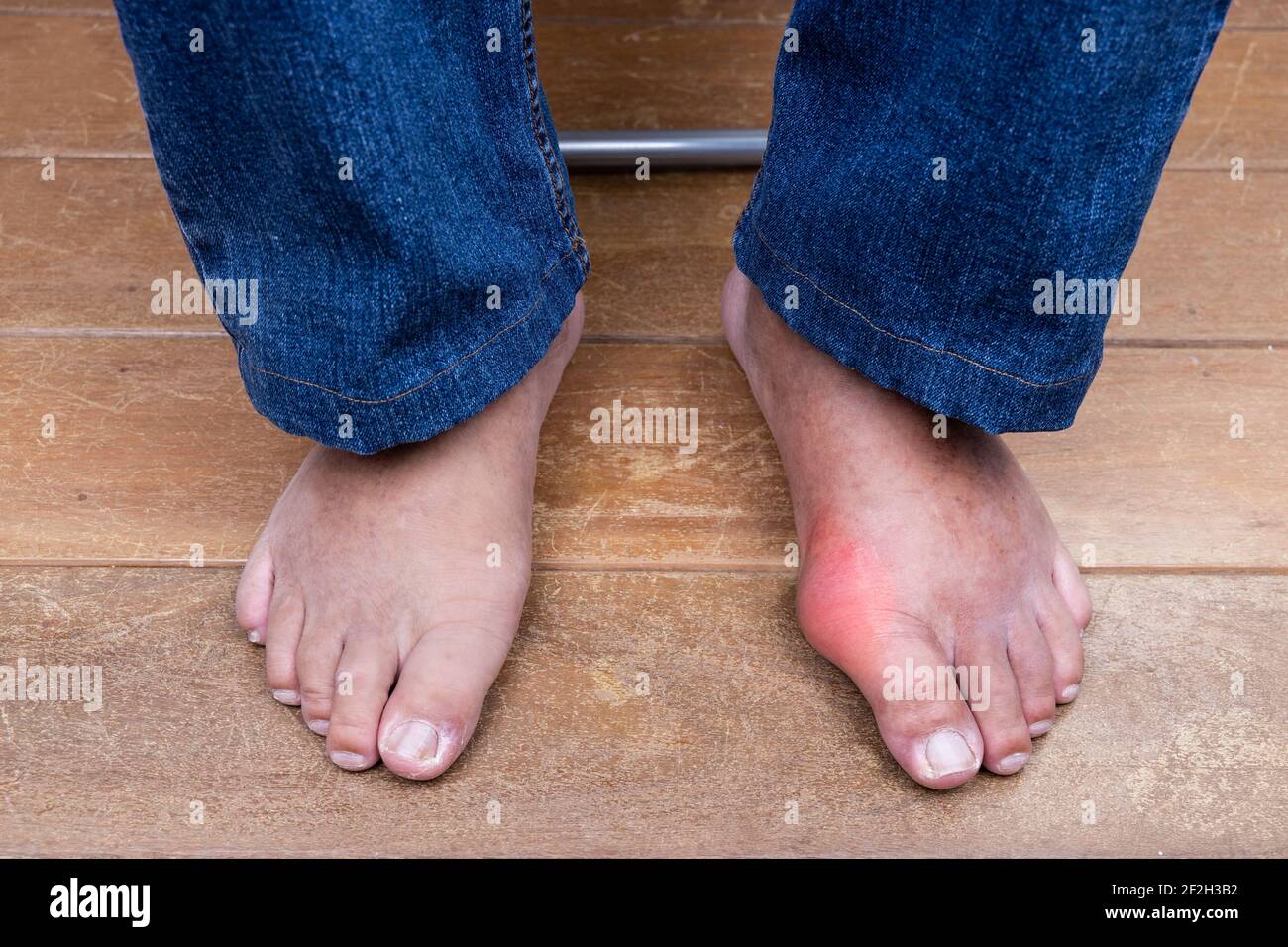 Gout Toe High Resolution Stock Photography and Images - Alamy