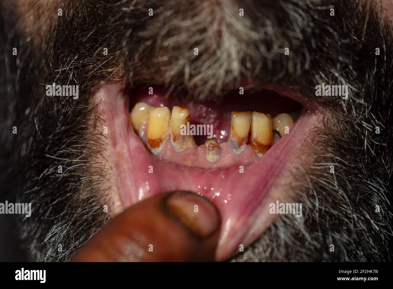 Dental problem concept. Unhealthy teeth man with caries tartar. The ...