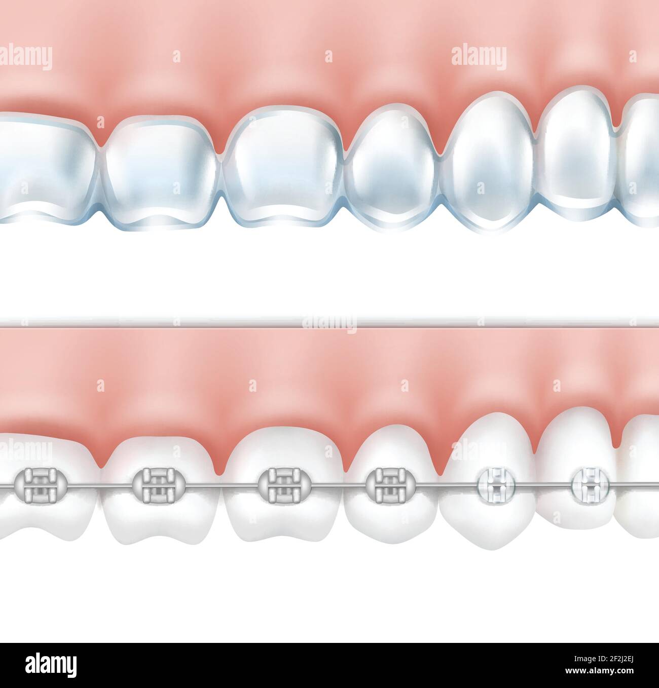 Vector human teeth with metal braces and whitening tray side view ...