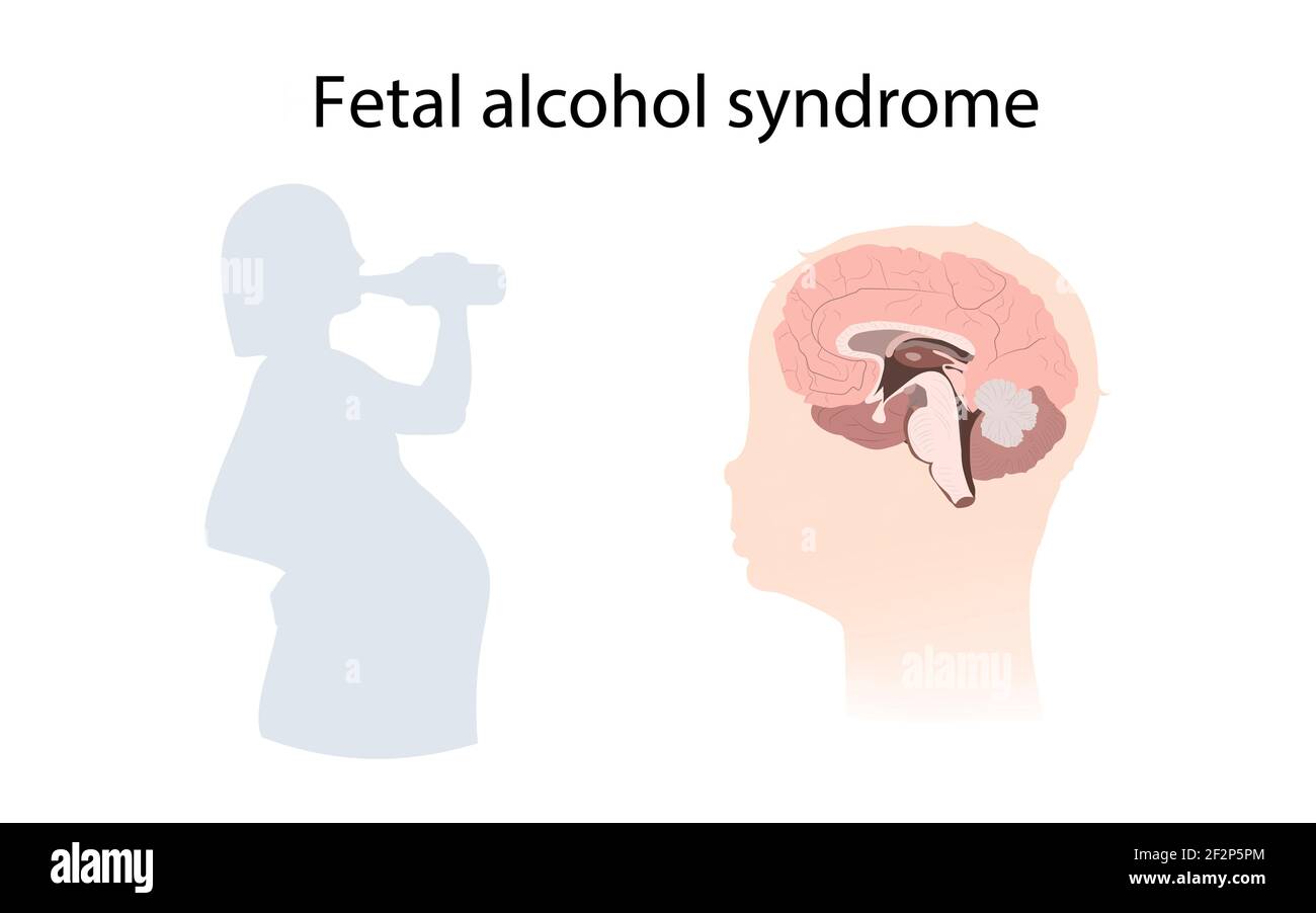 Foetal alcohol syndrome hi-res stock photography and images - Alamy