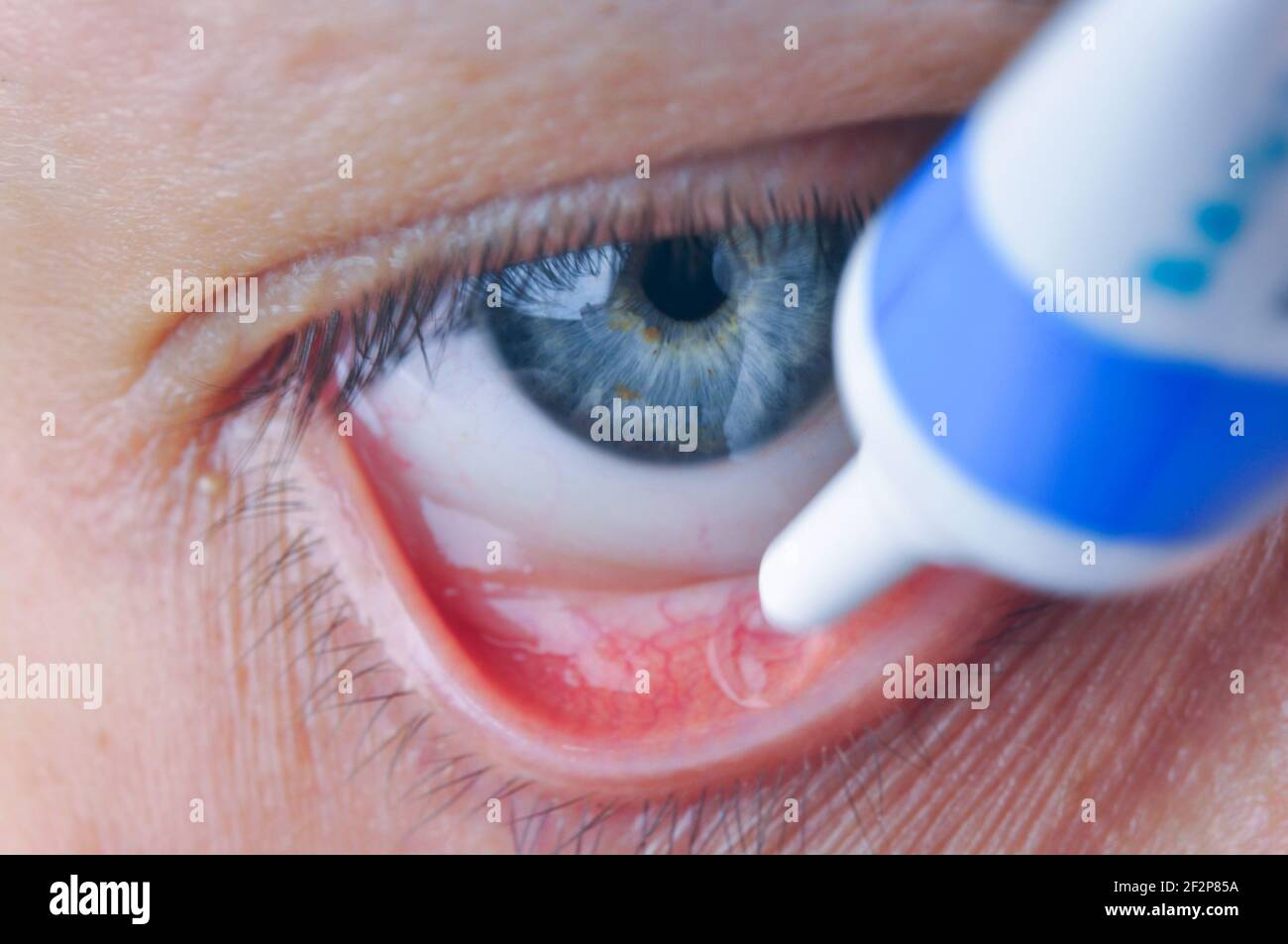 Conjunctival sac hi-res stock photography and images - Alamy