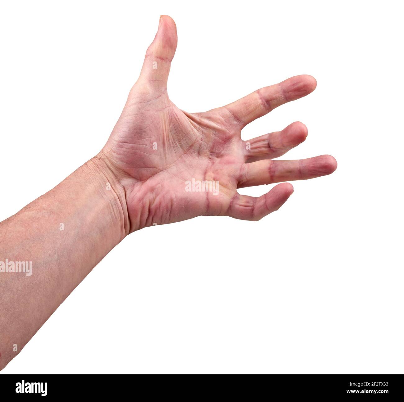 Hand of an man with Dupuytren contracture disease, Isolated on white ...