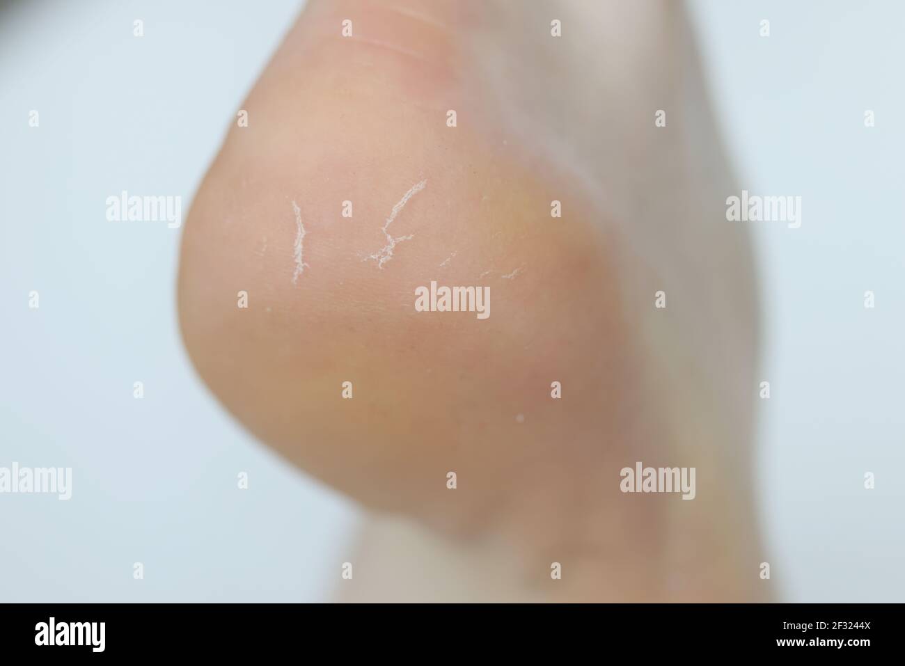 Heel skin hi-res stock photography and images - Alamy