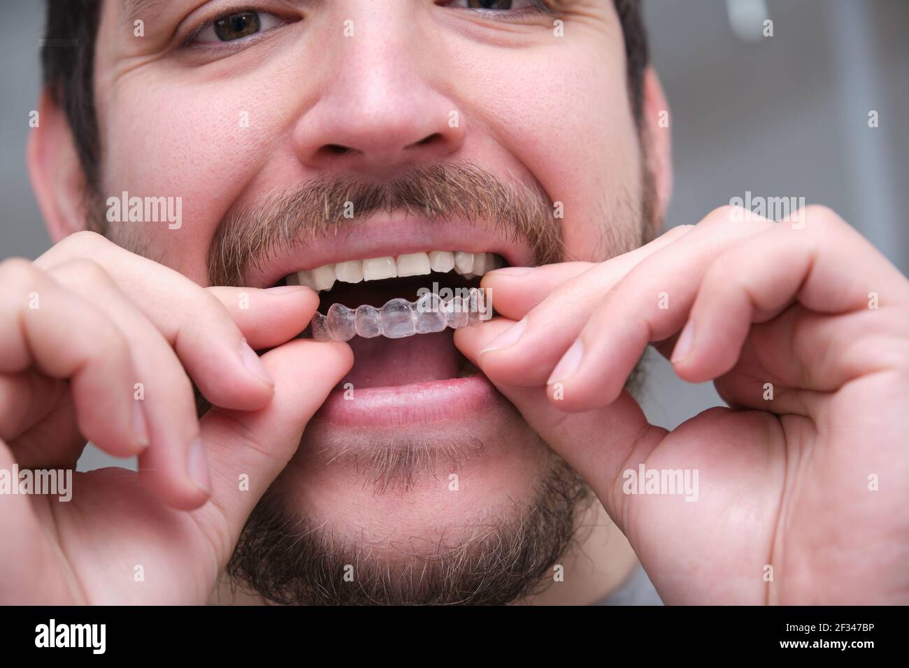 Man with braces hi-res stock photography and images - Alamy
