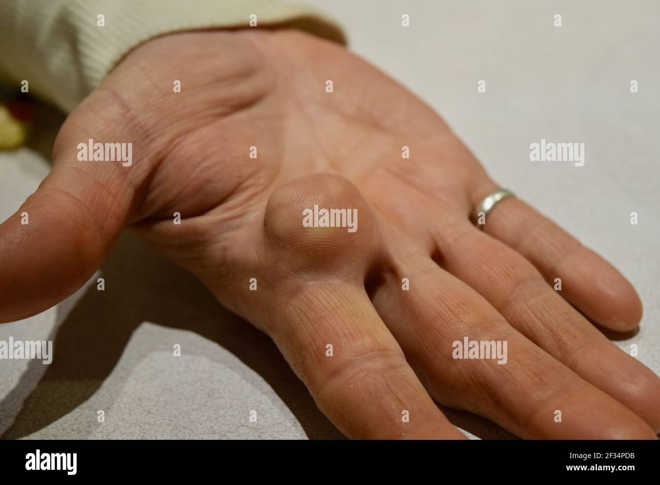 A Closeup Top View Of A Woman Showing A Round Shaped Lipoma Fatty Tumor On An Open Palm Stock