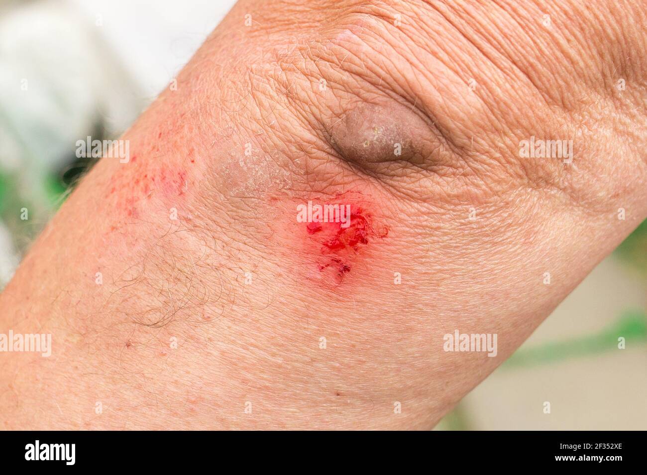 Damaged or torn wound to the elbow with the blood of an elderly person ...