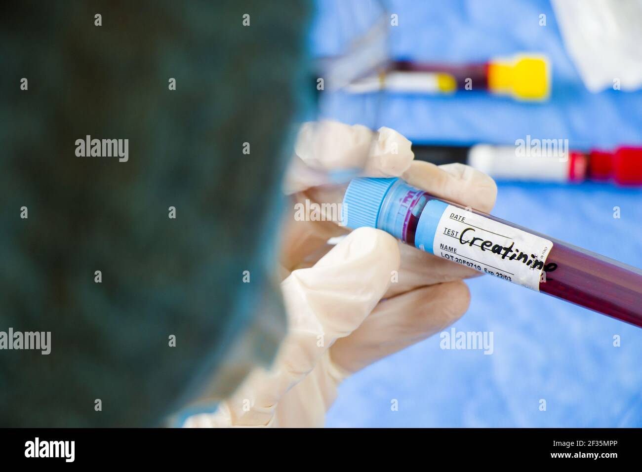 A doctor holding a creatinine blood test tube sample in a laboratory ...