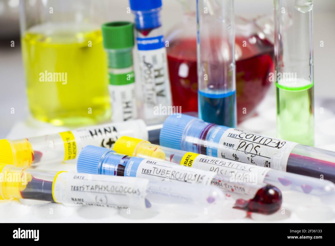 Positive test tuberculosis hi-res stock photography and images - Alamy