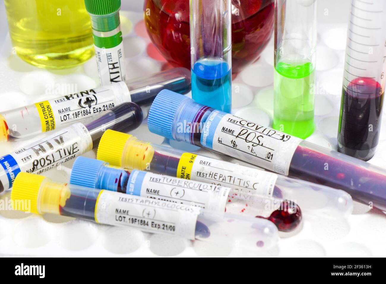 Positive test tuberculosis hi-res stock photography and images - Alamy