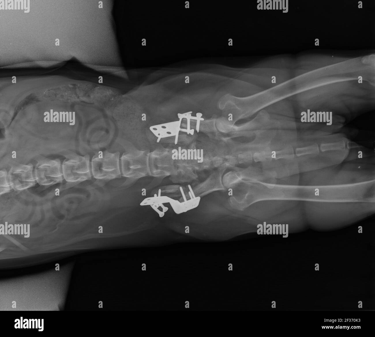 Triple pelvic osteotomy hi-res stock photography and images - Alamy