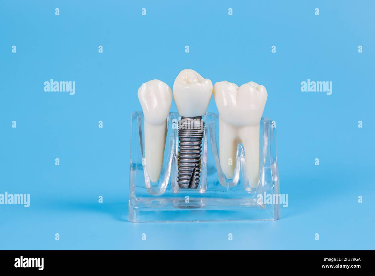 Plastic dental crowns, imitation of a dental prosthesis of a dental ...