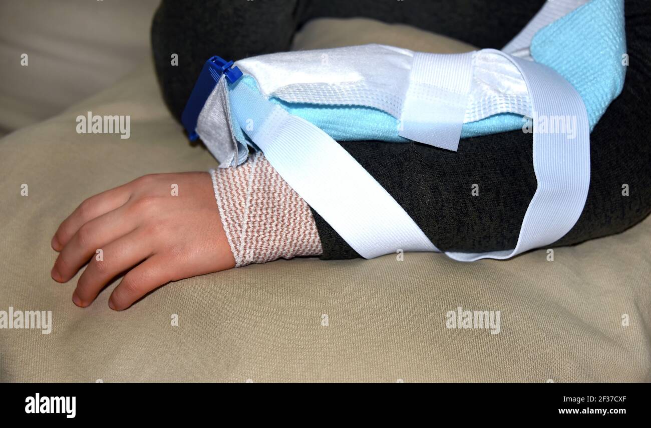 Little girl rests her injured arm on a pillow at her house. She has an ...