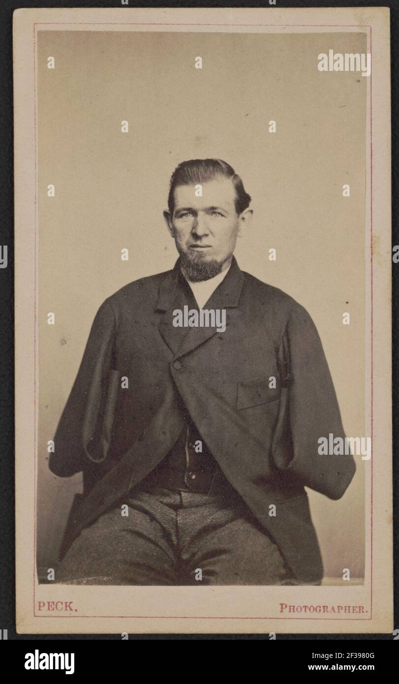Private George W. Warner of Co. B, 20th Connecticut Infantry Regiment with amputated arms ...
