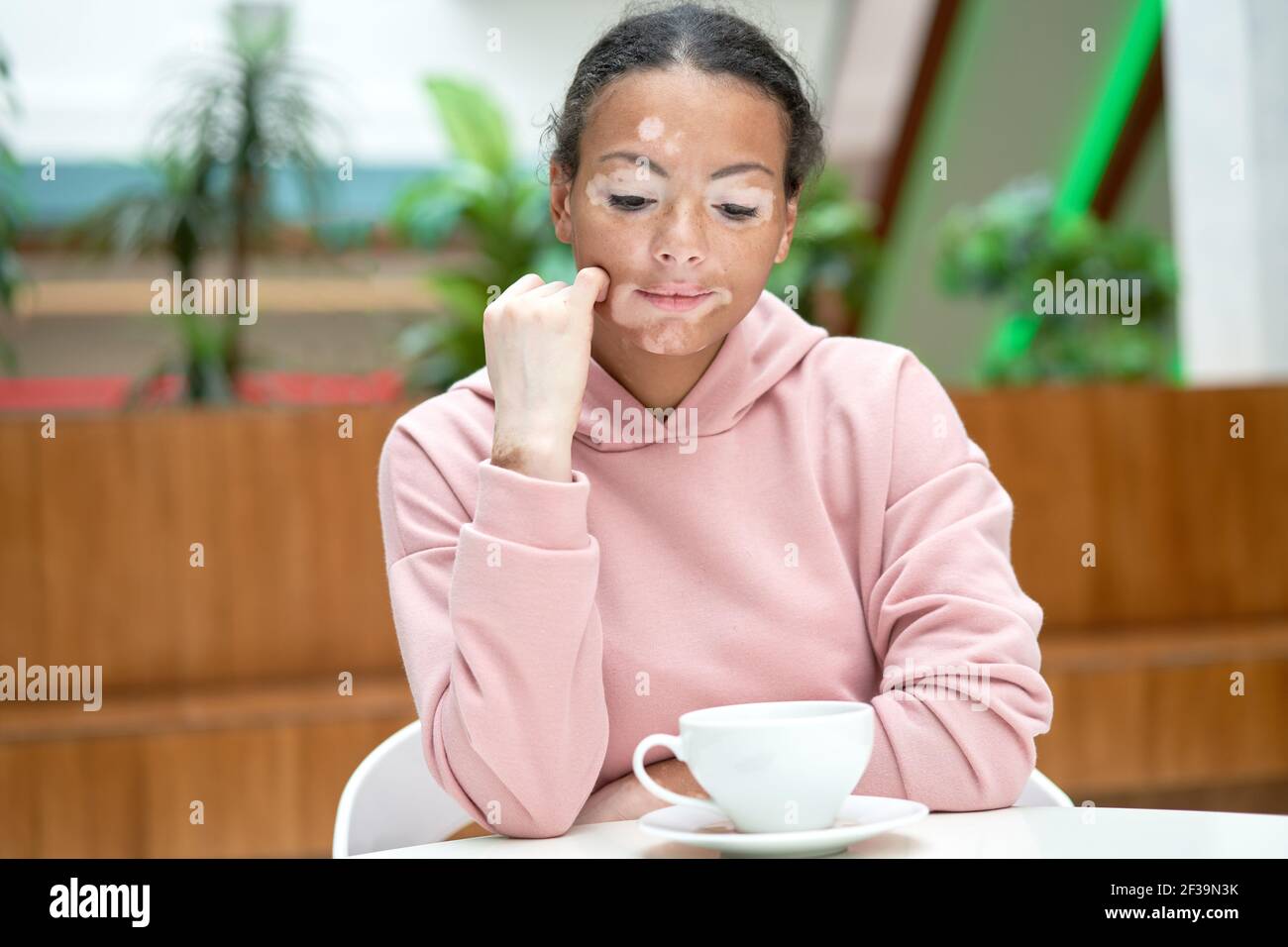 Vitiligo Skin Condition High Resolution Stock Photography and Images ...