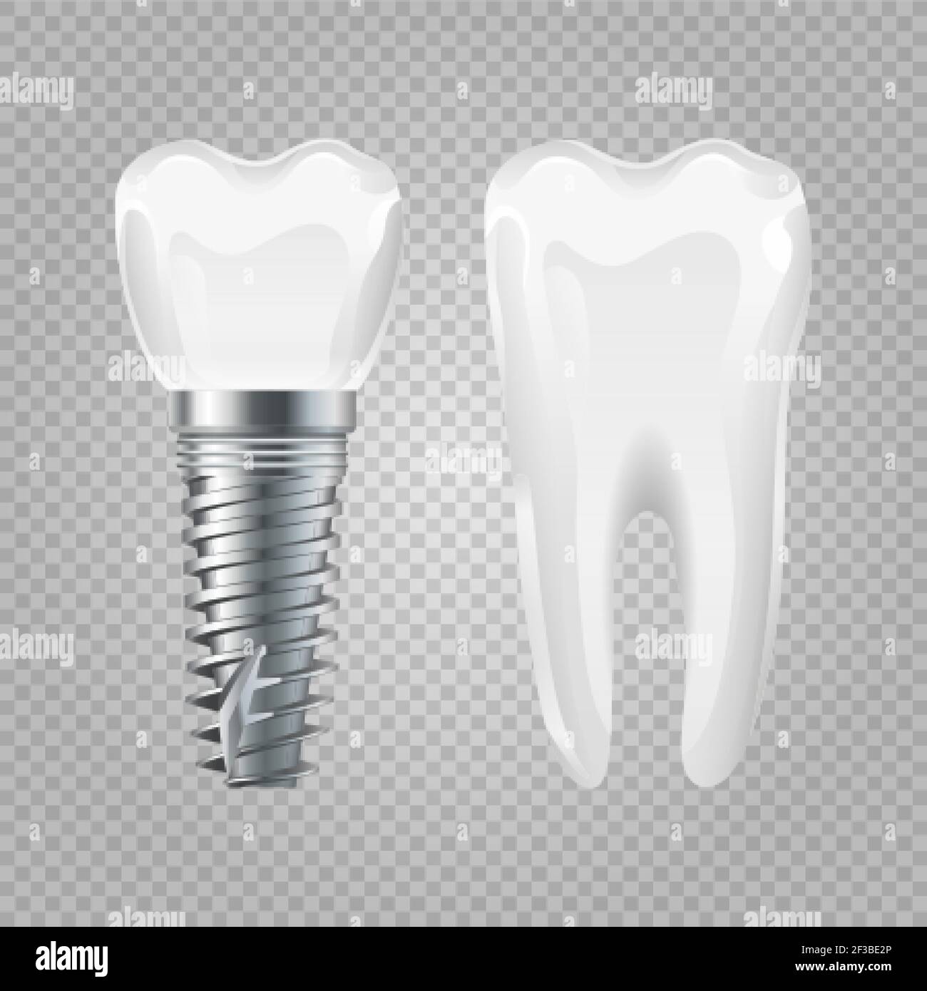 Dental implant. Realistic healthy tooth and implant. Vector dental ...