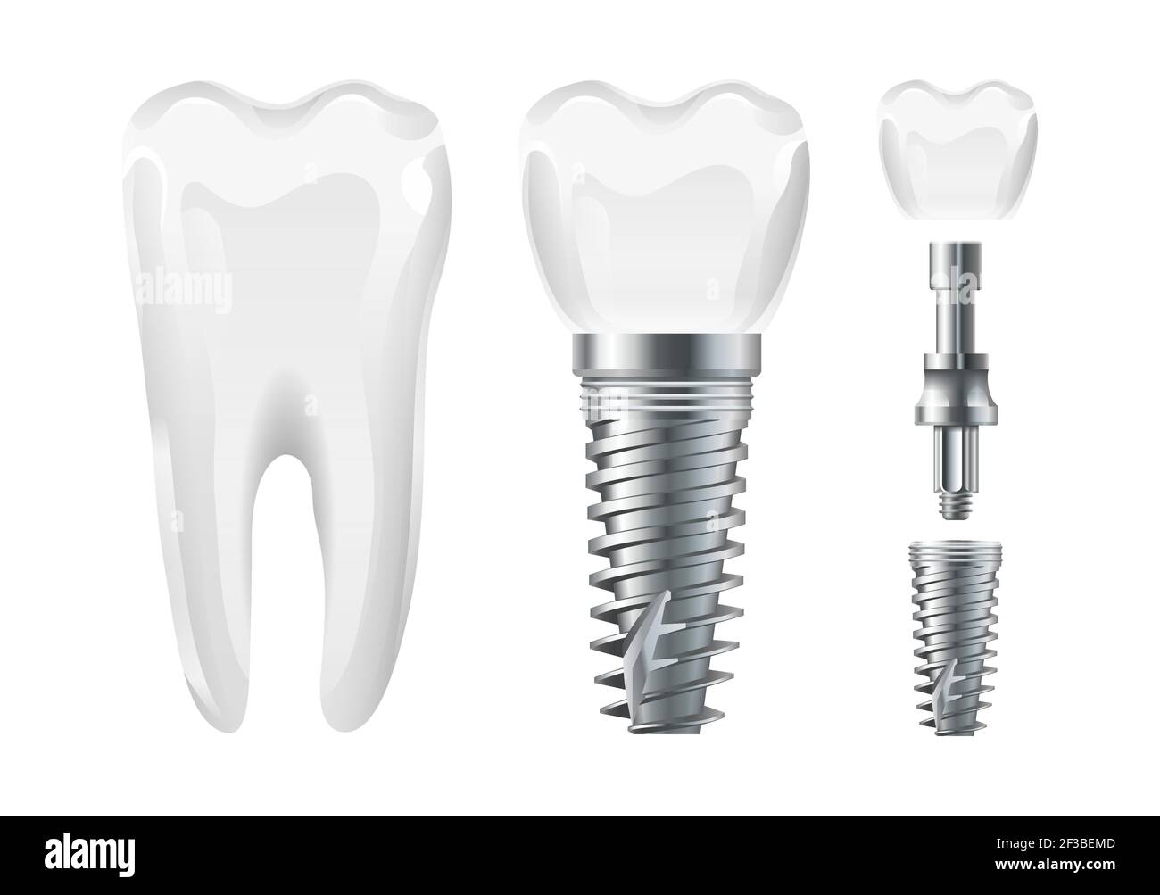 Dental surgery. Implant cut and healthy tooth. Realistic vector dental ...