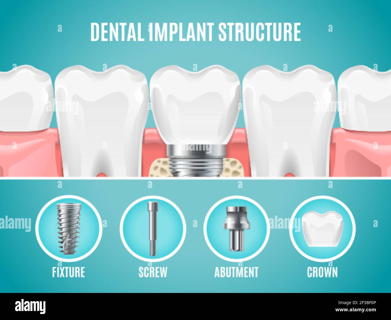 Dental implant structure. Vector reallistic tooth implant cut. Dental ...