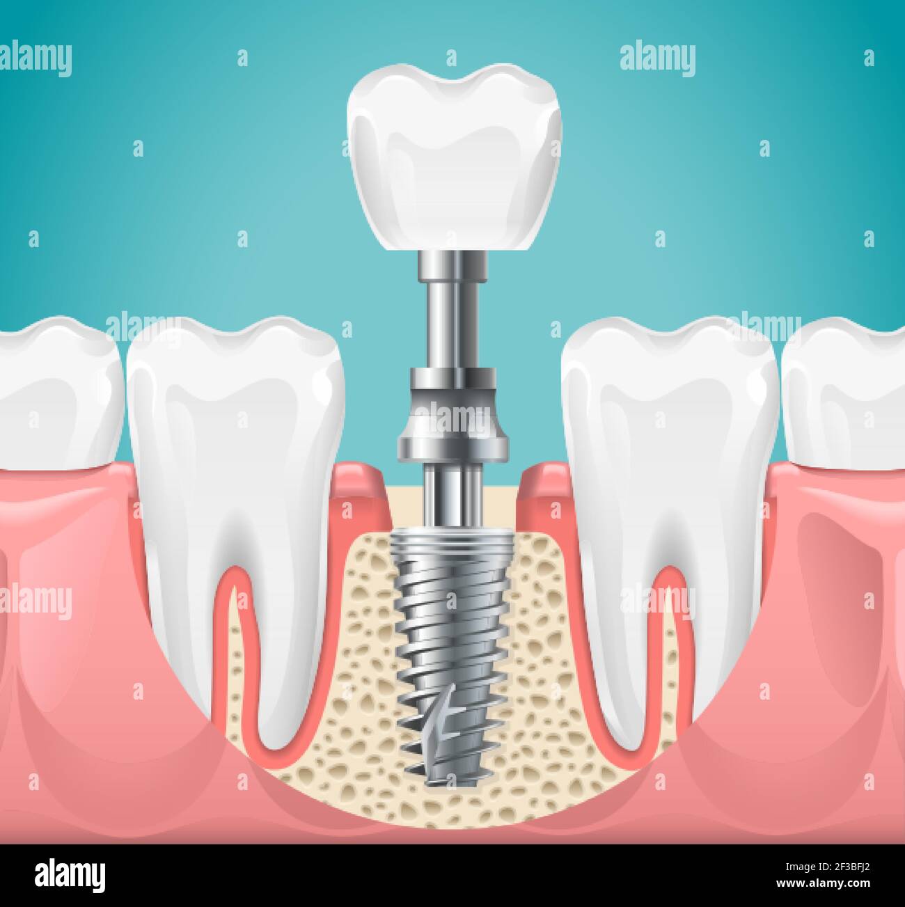 Dental surgery. Tooth implant cut vector illustration. Healthy teeth ...