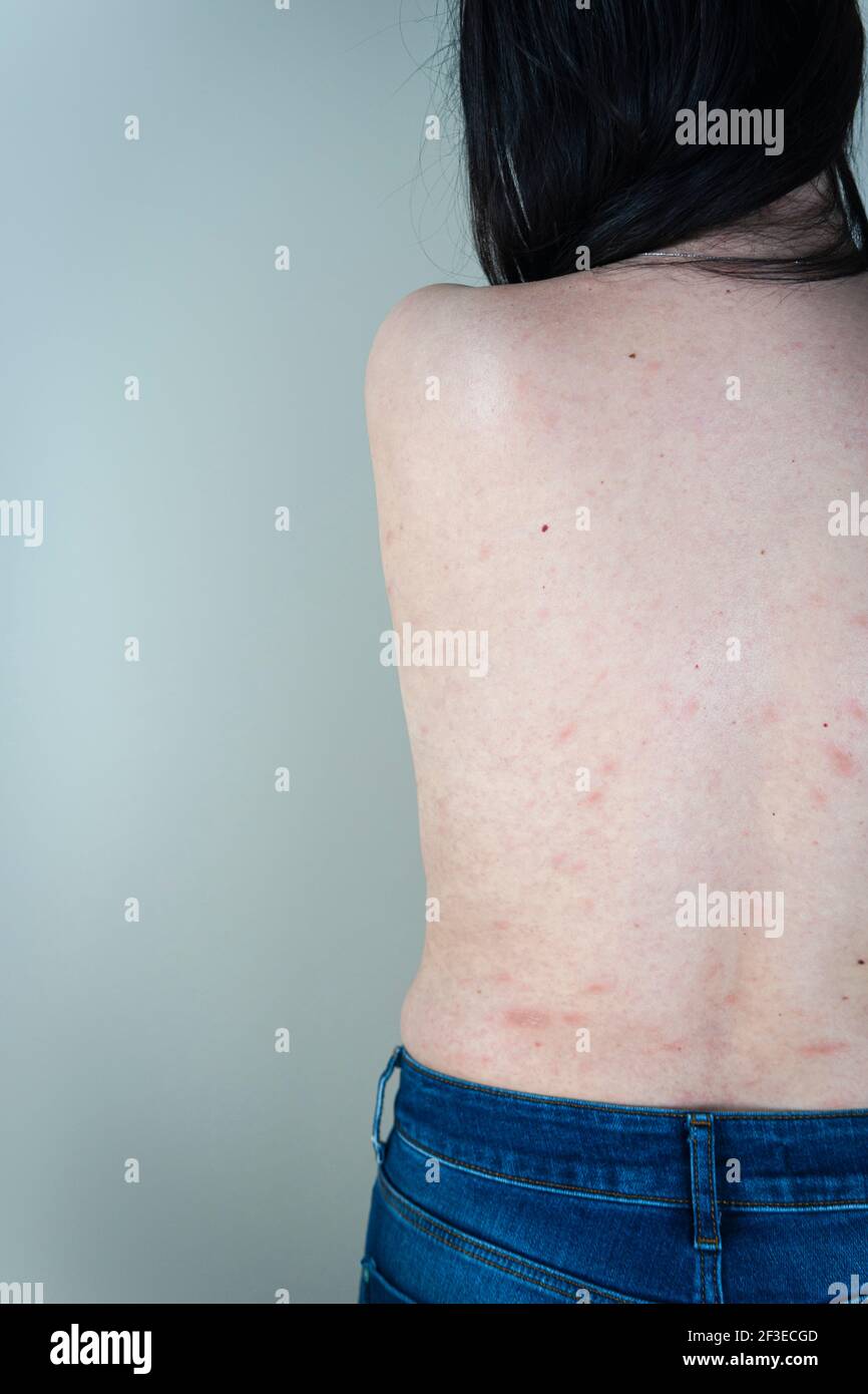 Women with symptoms of itchy urticaria or allergic reaction on the skin ...