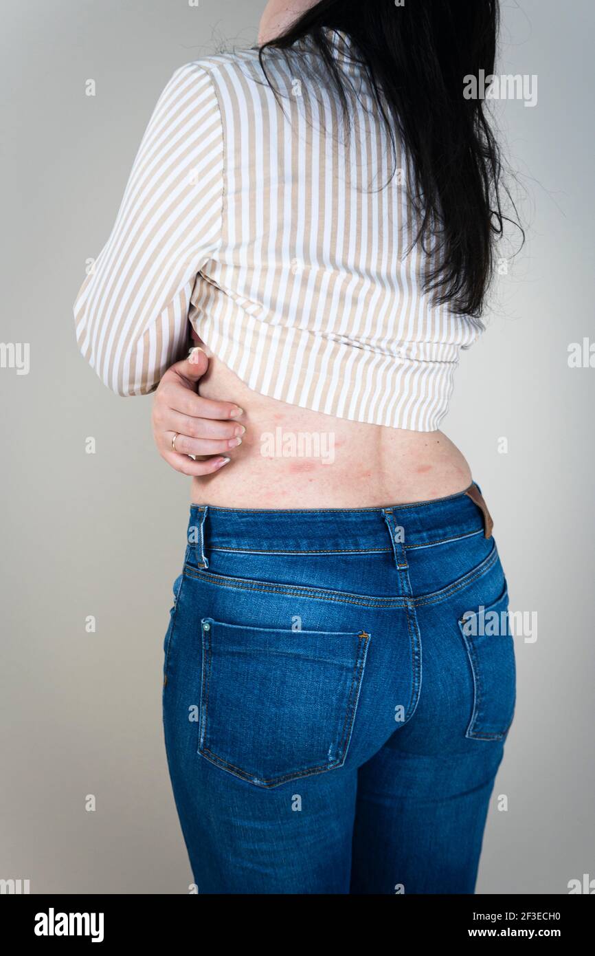 Women with symptoms of itchy urticaria or allergic reaction on the skin ...