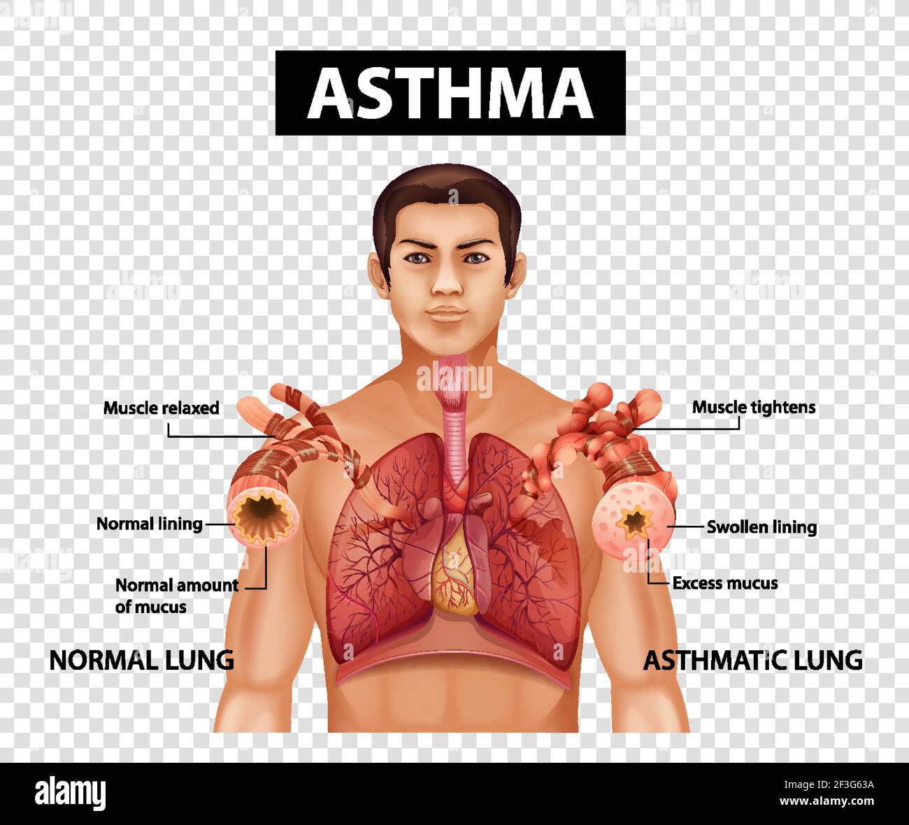 Diagram showing Asthma on transparent background illustration Stock ...