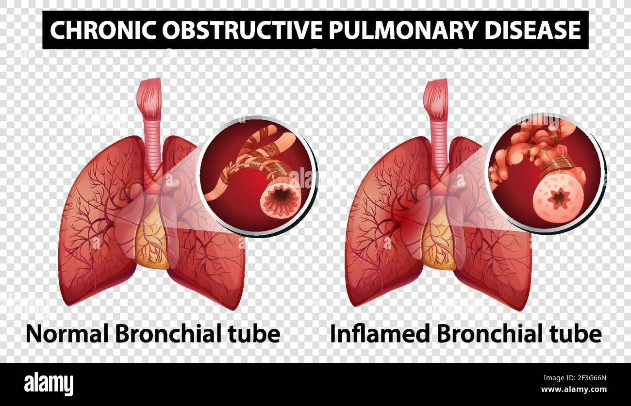 Diagram showing chronic obstructive pulmonary disease on transparent ...