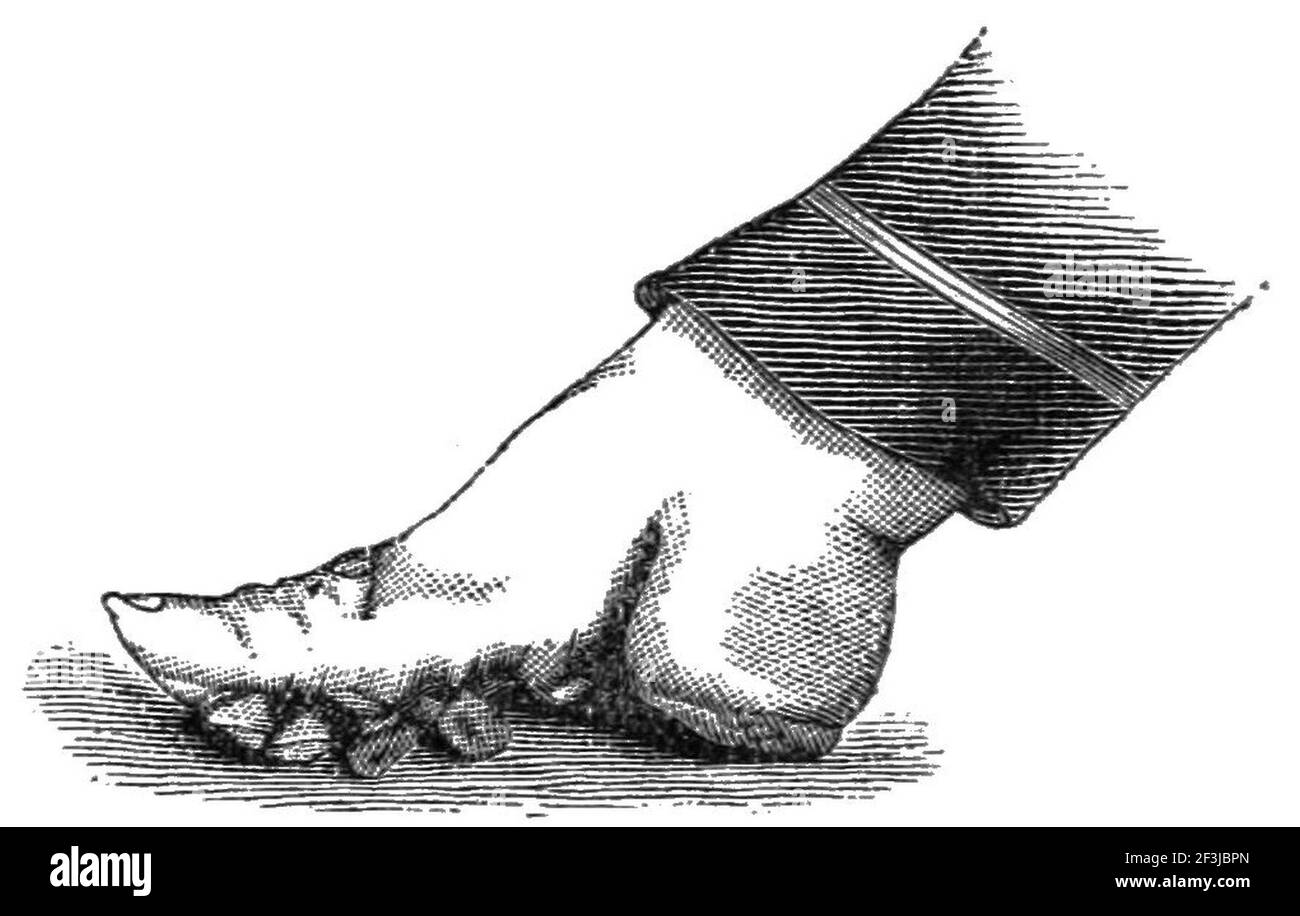 Distorted foot of a chinese woman Stock Photo - Alamy