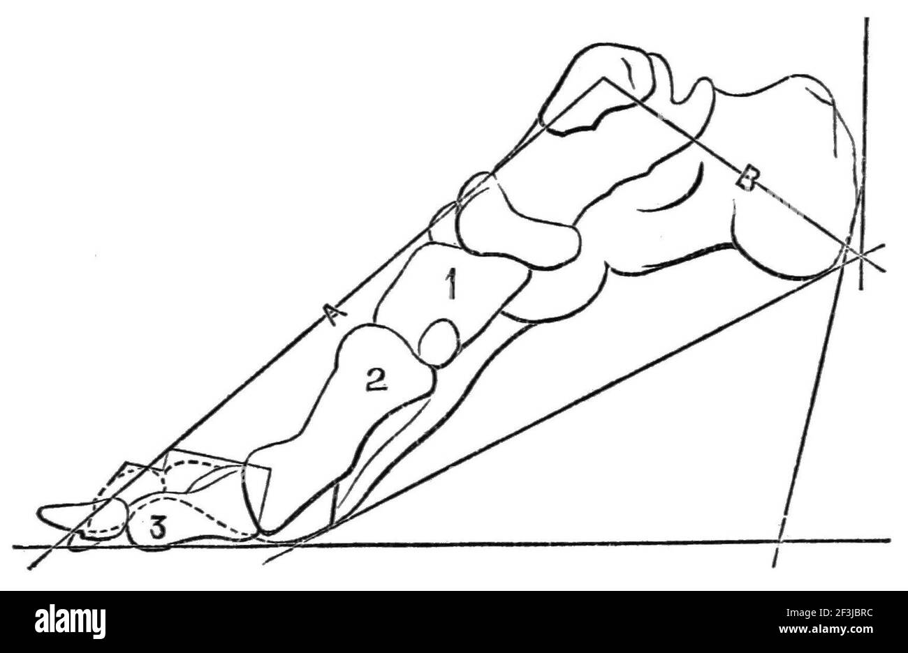 Deforming pressure of high heels on the foot bone structure Stock Photo ...