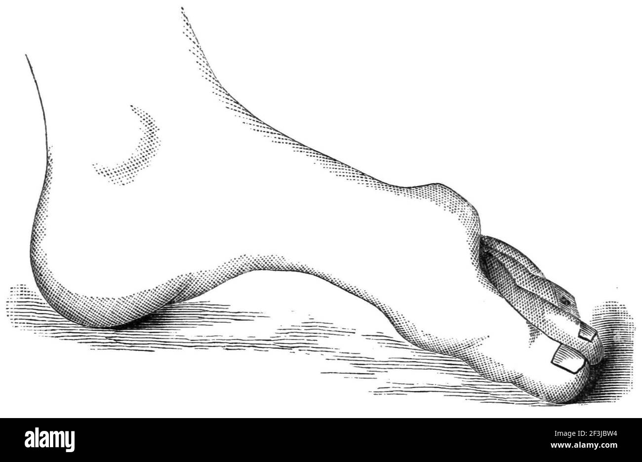 Foot deformed by inflammation of the joints Stock Photo - Alamy