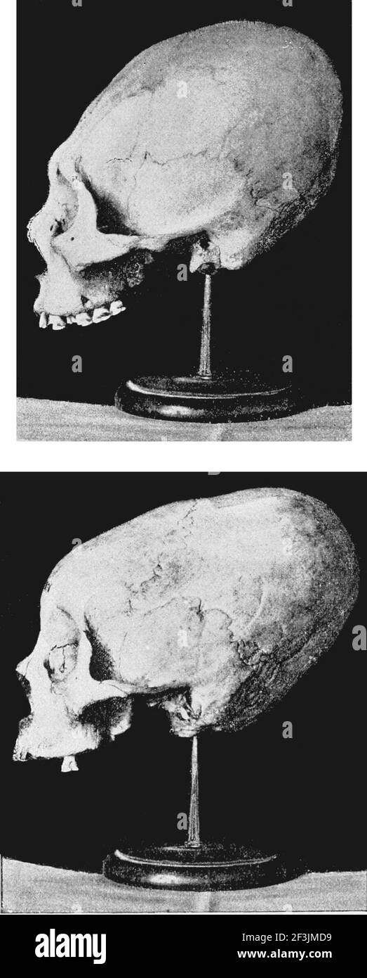 Deformed skulls hi-res stock photography and images - Alamy