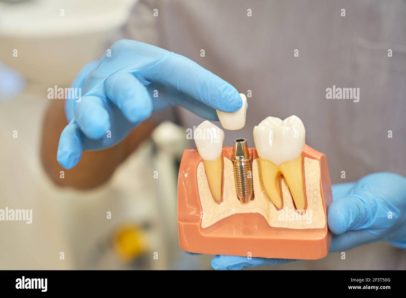 Plastic prop of teeth implant being shown by dentist Stock Photo - Alamy
