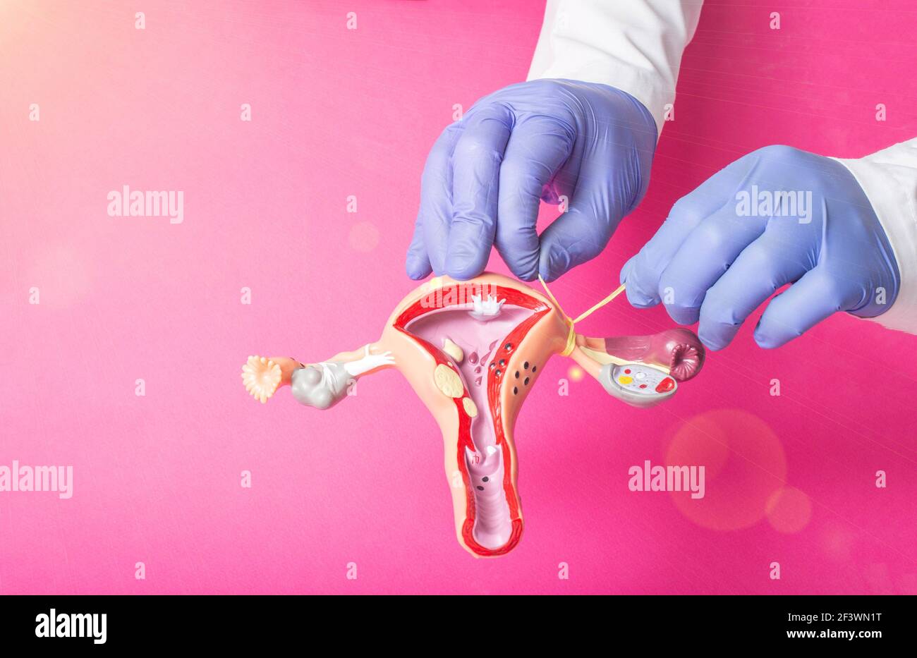 Tubal ligation hi-res stock photography and images - Alamy