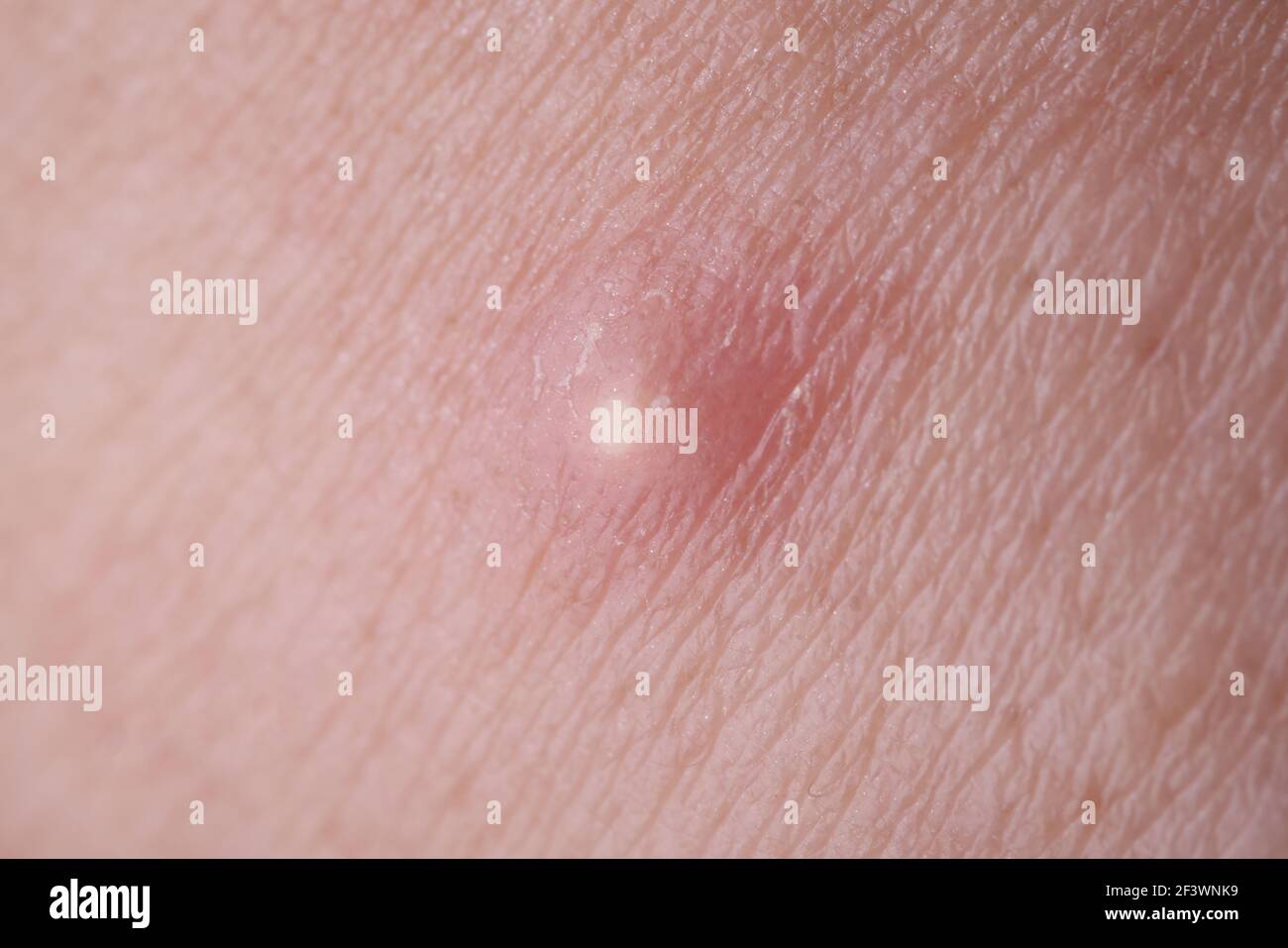 Purulent hi-res stock photography and images - Alamy